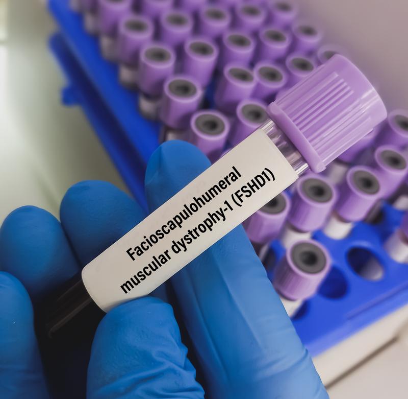 News: Modalis Partners with SOLVE FSHD to Develop CRISPR Therapy for ...